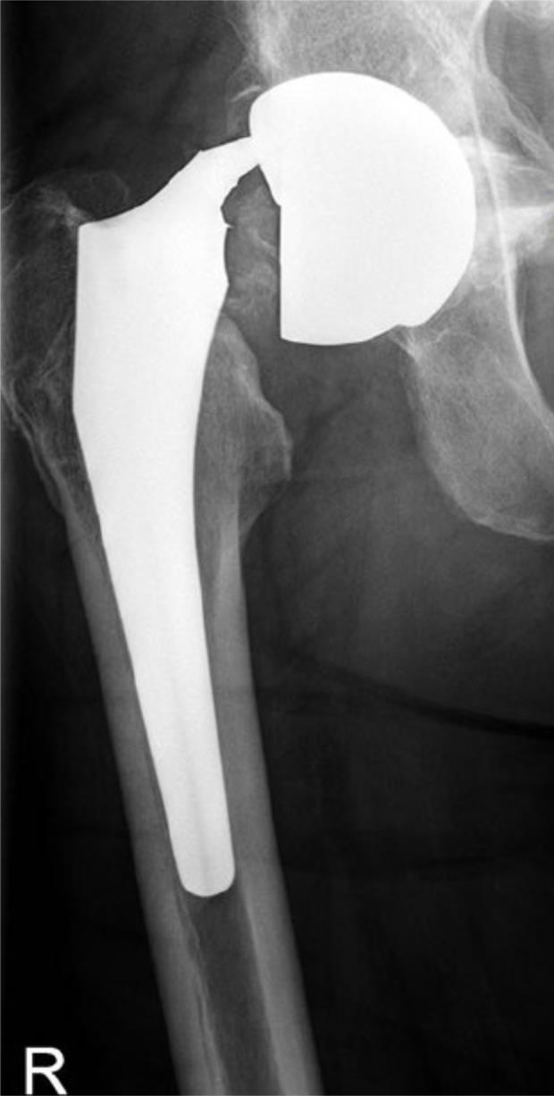 Question 219492 - Qbank - Orthobullets