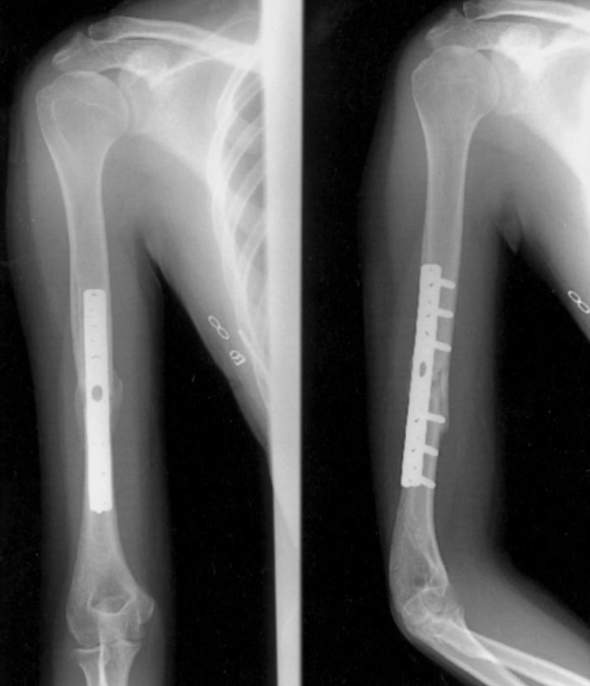 Question 219495 - Qbank - Orthobullets