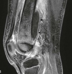 Question 2213 - Qbank - Orthobullets