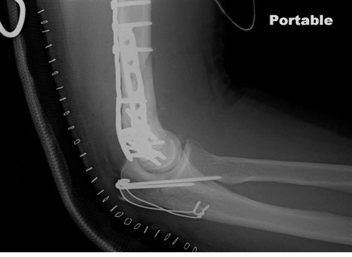 Distal Humerus Fractures - Trauma - Orthobullets