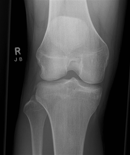 ACL Tear - Knee & Sports - Orthobullets