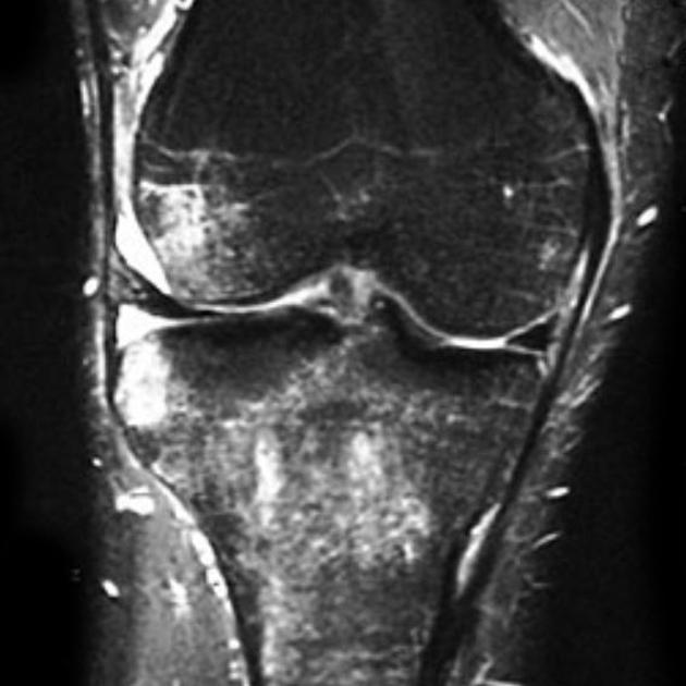 ACL Tear - Knee & Sports - Orthobullets