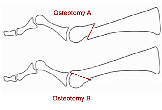DJD & Hallux Rigidus - Foot & Ankle - Orthobullets