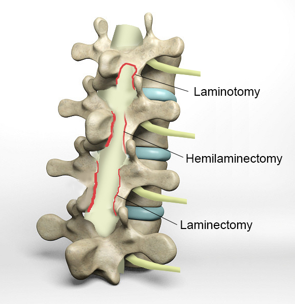 Lumbar Disc Herniation - Spine - Orthobullets