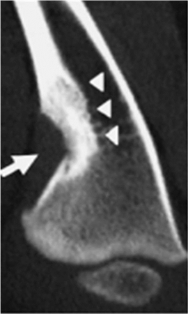 Focal Fibrocartilaginous Dysplasia - Pathology - Orthobullets