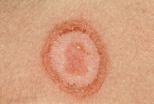 Community-acquired methicillin-resistant Staphylococcus aureus: an ...