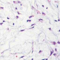 Intramuscular Myxomas - Pathology - Orthobullets