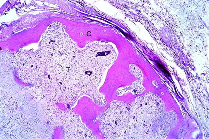 Osteofibrous Dysplasia - Pathology - Orthobullets