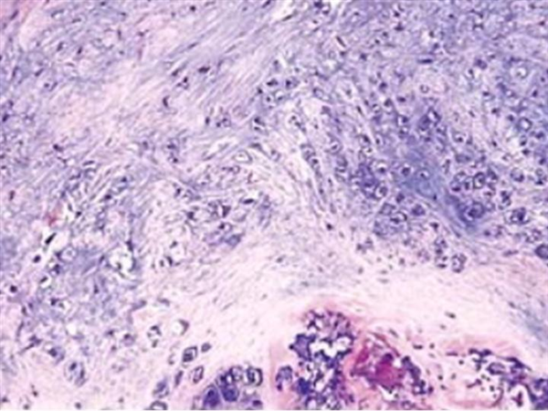 Osteochondroma & Multiple Hereditary Exostosis - Pathology - Orthobullets