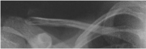 Distal Clavicle Physeal Fractures - Pediatrics - Orthobullets