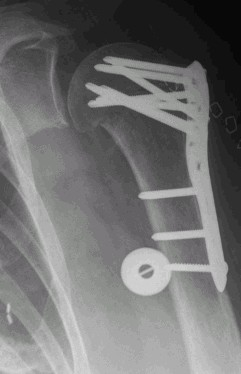 Proximal Humerus Fractures - Trauma - Orthobullets