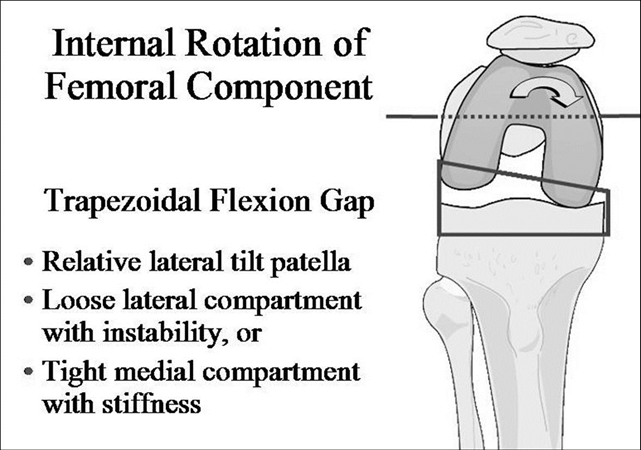 TKA Patellofemoral Alignment - Recon - Orthobullets