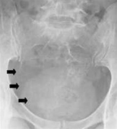 Giant Cell Tumor - Pathology - Orthobullets