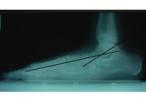 Flexible Pes Planovalgus (Flexible Flatfoot) - Pediatrics - Orthobullets