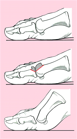 DJD & Hallux Rigidus - Foot & Ankle - Orthobullets
