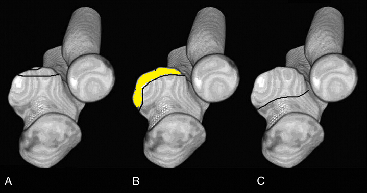 Elbow Dislocation - Trauma - Orthobullets