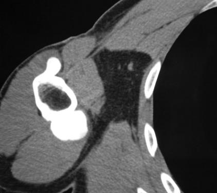 Parosteal Osteosarcoma - Pathology - Orthobullets