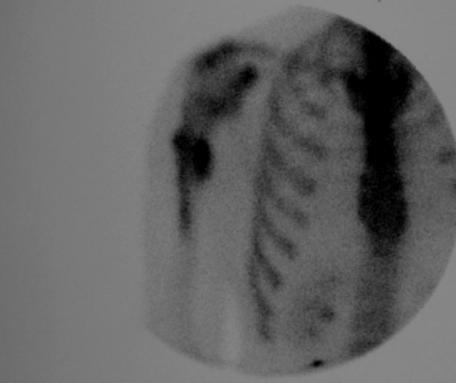 Parosteal Osteosarcoma - Pathology - Orthobullets