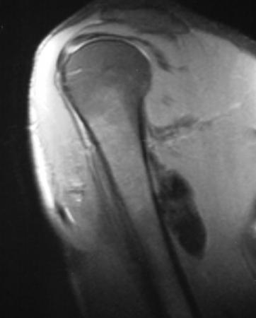 Parosteal Osteosarcoma - Pathology - Orthobullets