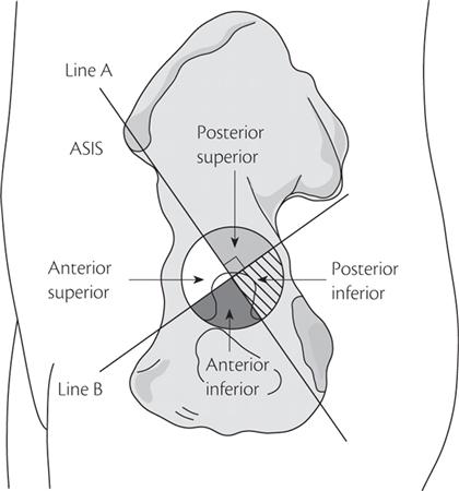 THA Acetabular Screw Fixation - Recon - Orthobullets
