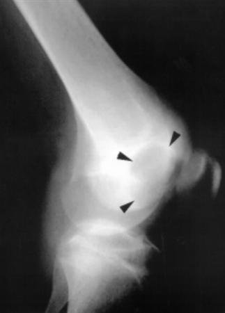 Chondroblastoma - Pathology - Orthobullets