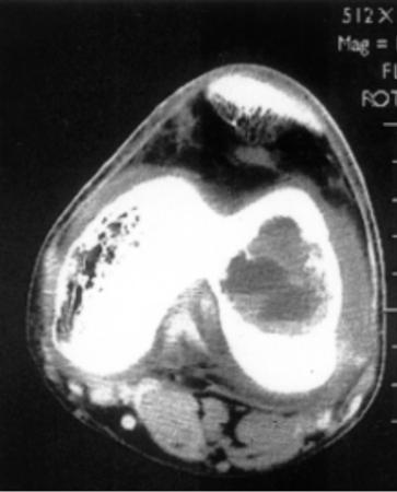 Chondroblastoma - Pathology - Orthobullets