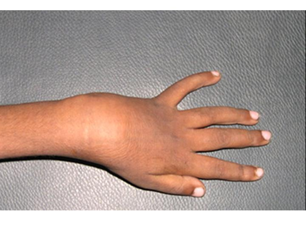 Septic Arthritis Hand