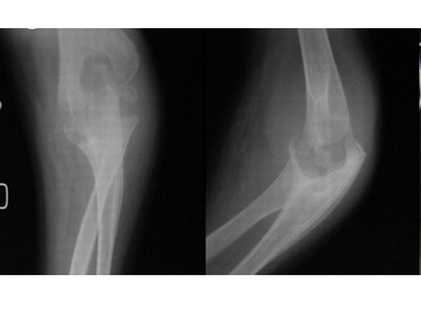 Osteomyelitis - Pediatric - Pediatrics - Orthobullets