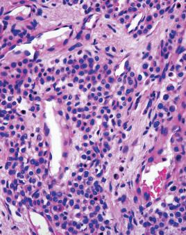 Glomus Tumor - Pathology - Orthobullets