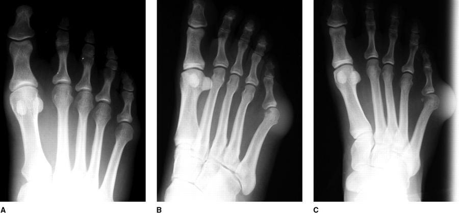 Bunionette Deformity - Foot & Ankle - Orthobullets