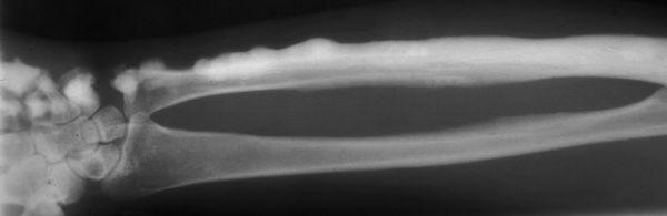 Osteopetrosis - Pediatrics - Orthobullets