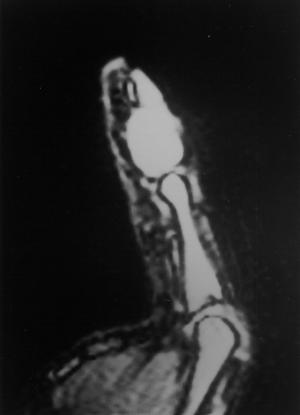 Enchondromas - Pathology - Orthobullets