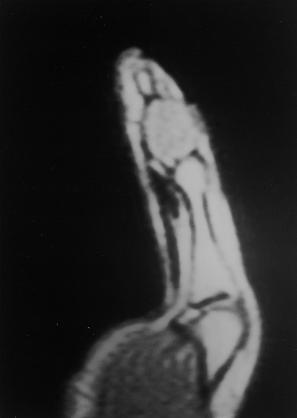 Enchondromas - Pathology - Orthobullets