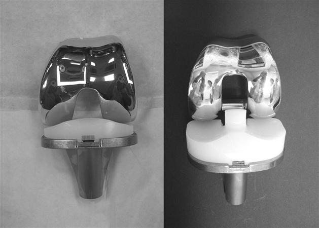 TKA Revision - Recon - Orthobullets