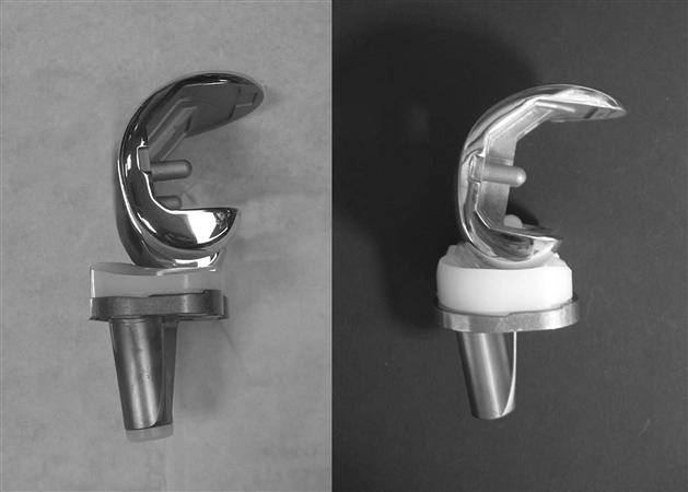 TKA Revision - Recon - Orthobullets