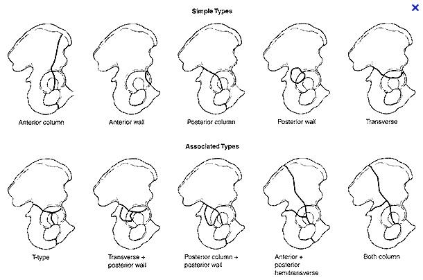 Acetabular Fractures - Trauma - Orthobullets