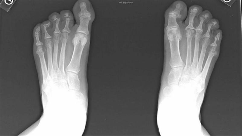 Psoriatic Arthritis - Basic Science - Orthobullets