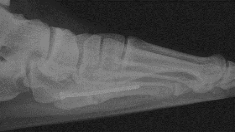 5th Metatarsal Base Fracture - Foot & Ankle - Orthobullets