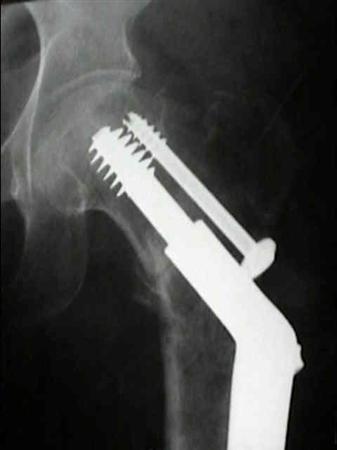 Intertrochanteric Fractures - Trauma - Orthobullets