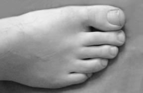 Osteochondroma & Multiple Hereditary Exostosis - Pathology - Orthobullets