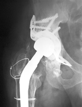 THA Revision - Recon - Orthobullets