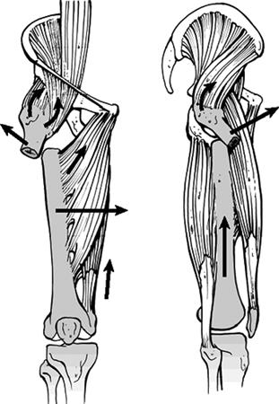 Subtrochanteric Fractures - Trauma - Orthobullets