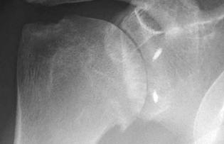 Question 3649 - Qbank - Orthobullets