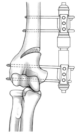 Question 3651 - Qbank - Orthobullets