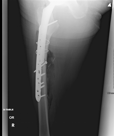 Question 366 - Qbank - Orthobullets