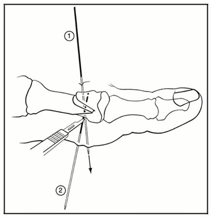 Hallux Valgus - Foot & Ankle - Orthobullets