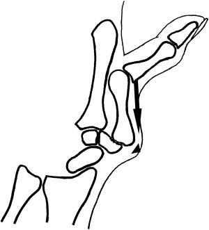 Basilar Thumb Arthritis - Hand - Orthobullets
