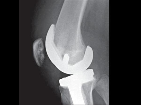 TKA Stiffness - Recon - Orthobullets