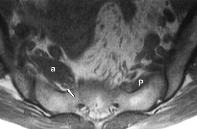 Piriformis - Anatomy - Orthobullets
