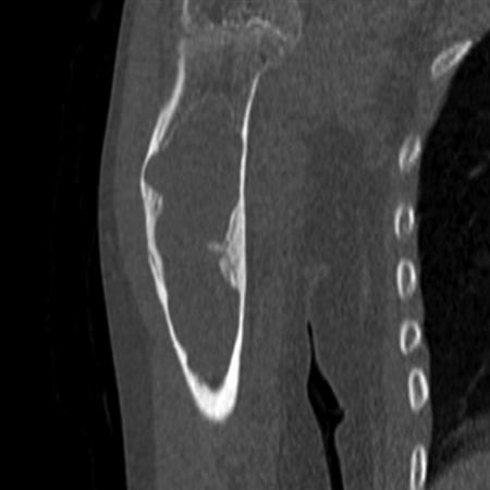 Unicameral Bone Cyst - Pathology - Orthobullets